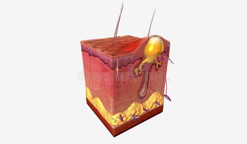 Pustules are a Type of Acne Characterized by Large, Inflamed Bumps with ...