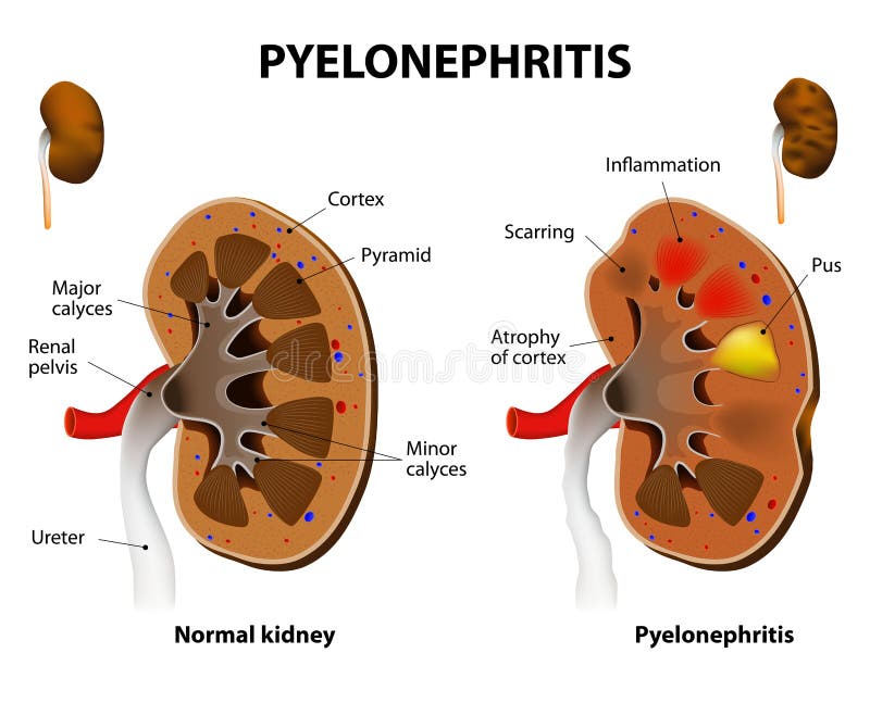 Kidney Chronic Pyelonephritis Stock Vector - Illustration of care ...
