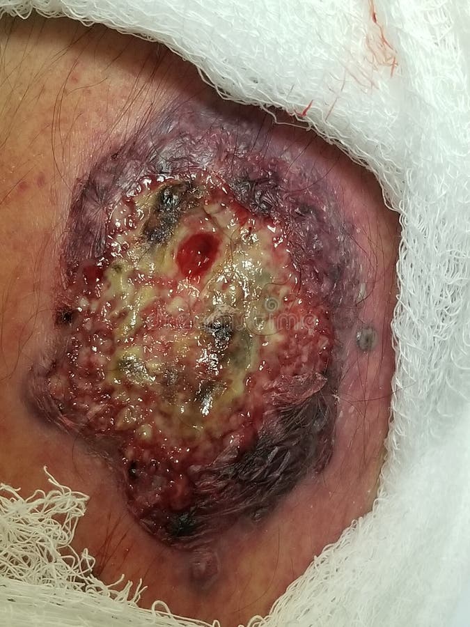 Pyoderma Gangrenosum on Leg of Patient with Ulcerative Colitis Stock ...
