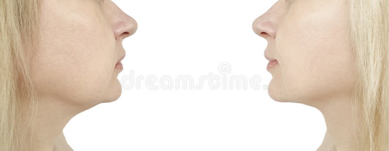 Queixo Da Mulher, Antes E Depois De Apertar O Procedimento Do Restauro ...