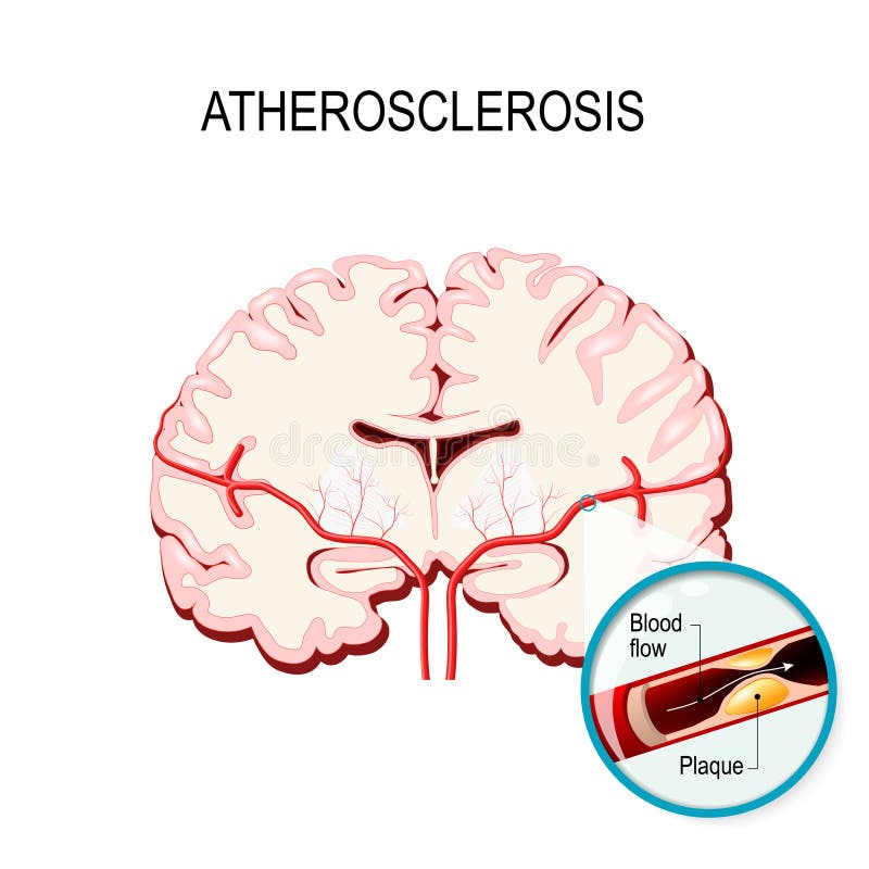 Querschnitt Des Menschlichen Gehirns Des Gehirns Mit Atherosclerose ... Querschnitt Des Menschlichen Gehirns Des Gehirns Mit Atherosclerose ...