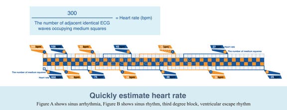 Quickly Estimate Heart Rate Stock Image - Image of electrocardiogram ...