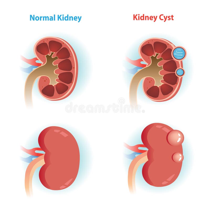 ícone Sólido Do Quisto Dos Rins Doenças Humanas Conceito De Tumor Com ...