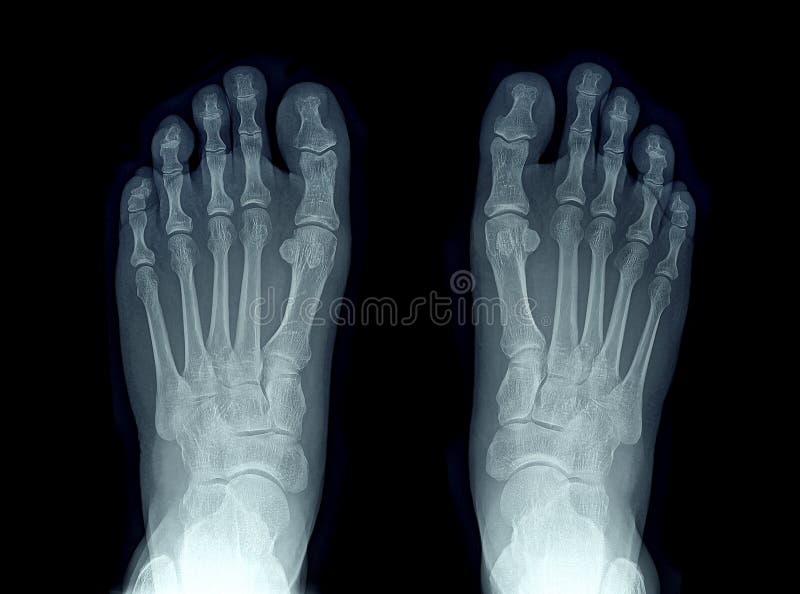 Röntgenbild von zwei Fuß stockfoto. Bild von diagnose - 60720028