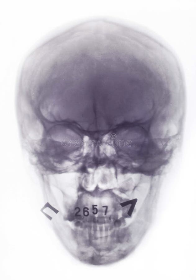 De Röntgenstraal Van De Schedel Stock Afbeelding - Afbeelding bestaande ...
