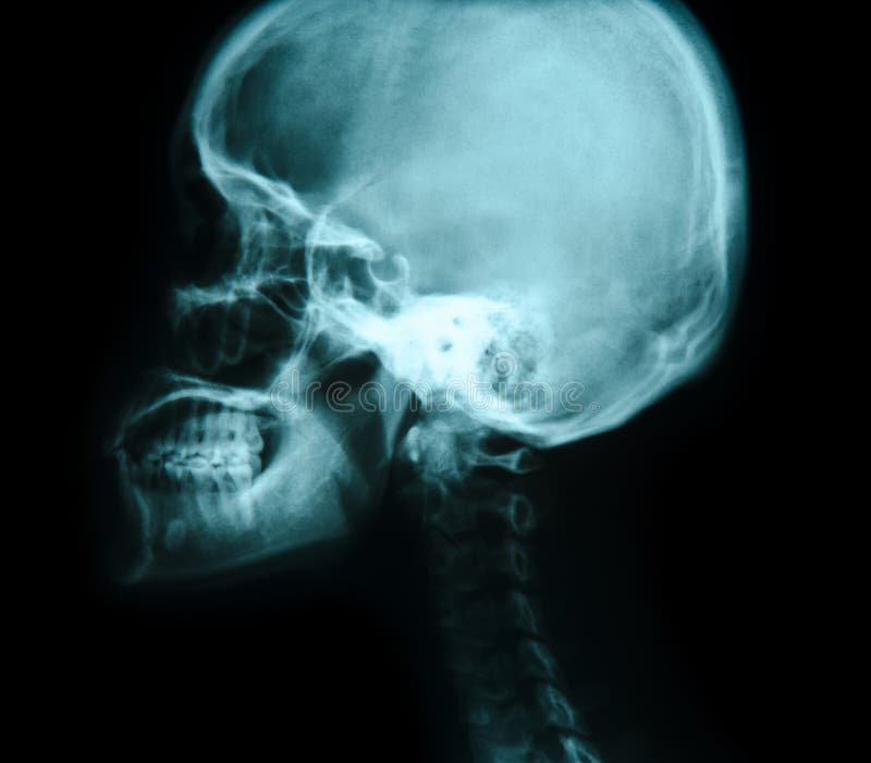 Röntgenfoto van de schedel stock afbeelding. Image of gebied - 43951557