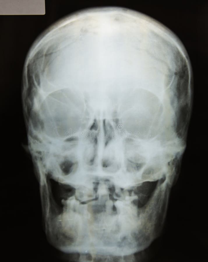 Normale Schedel En Cervicale Stekel Stock Foto - Afbeelding bestaande ...