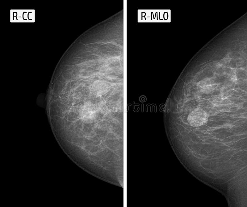 Magnetic Resonance Imaging Van Borst (MRI) Stock Afbeelding - Image of ...