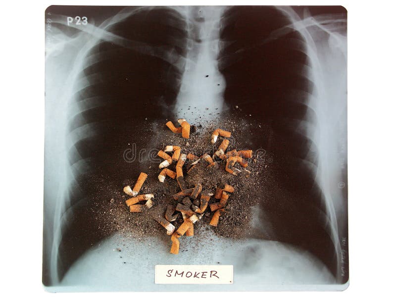 De longen van rokers stock foto. Image of gevolgen, roker - 945380