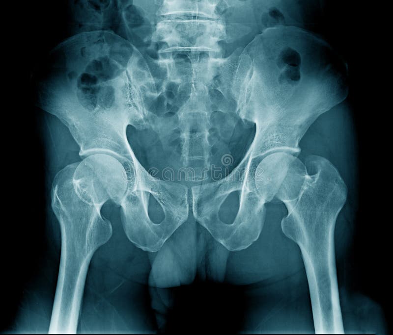Heup en bekkenbeen stock afbeelding. Image of radiografie - 115922161