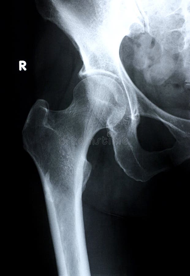 Xray, Klassieke Radiologie Van De Heup Stock Foto - Image of ...