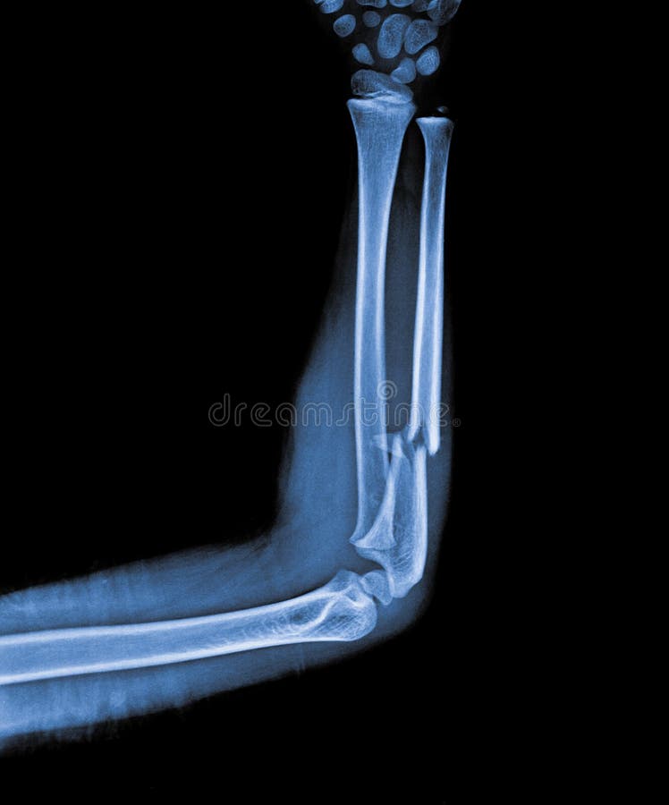 Breuk Van De Film X-ray Pols: Toon Het Been Van De Breukstraal Stock ...