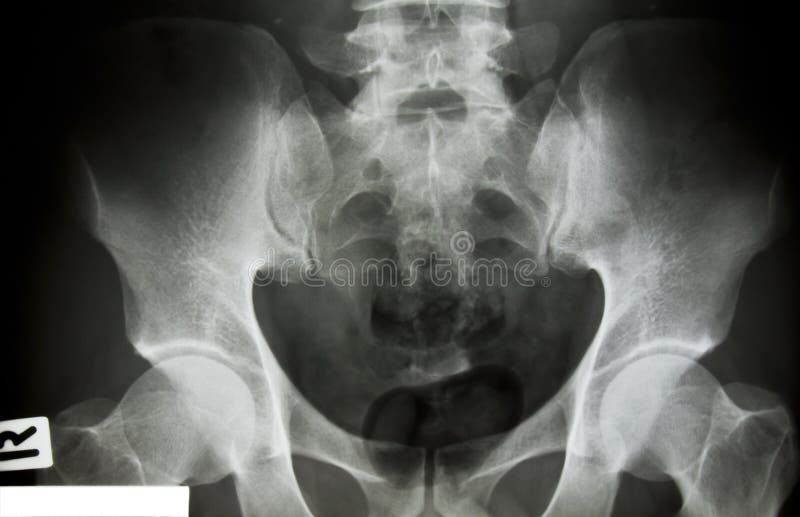 Röntgenstraal Van Het Bekken Stock Foto - Image of geneeskunde, kolom ...