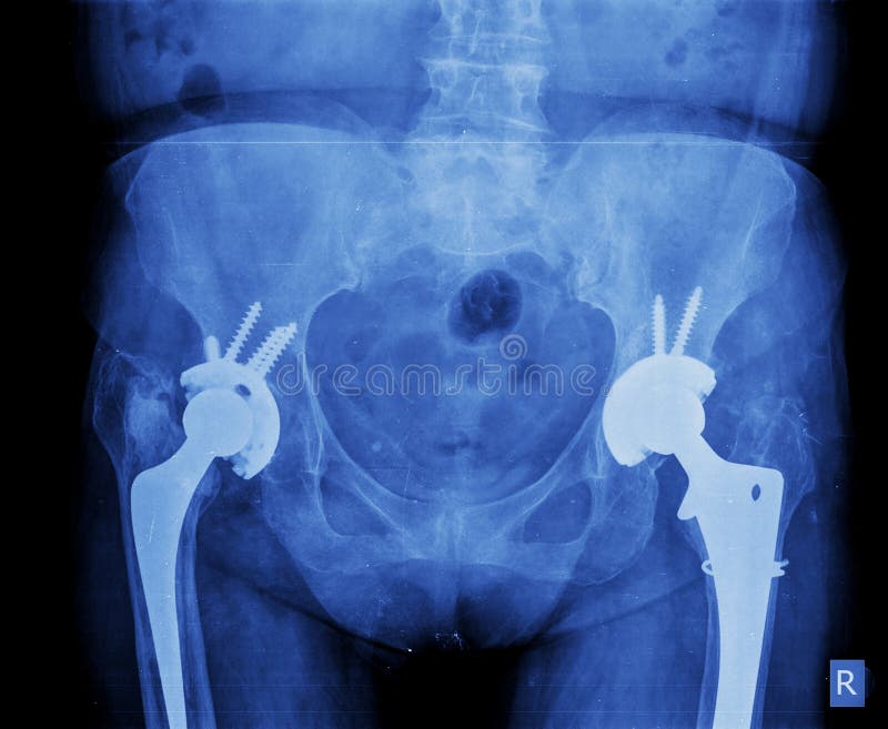 Röntgenstraal Van Heupprothese Stock Foto - Image of osteoporose ...