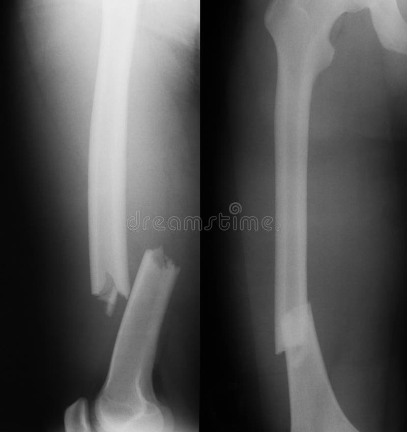 Gebroken Been (gebroken Scheenbeen) Radiografie Stock Foto - Image of ...