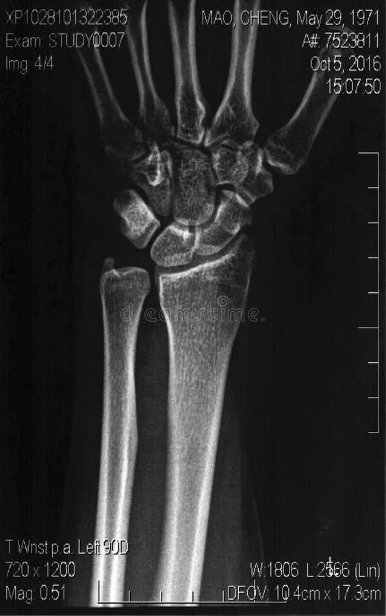 Breuk Van De Film X-ray Pols: Toon Het Been Van De Breukstraal Stock ...