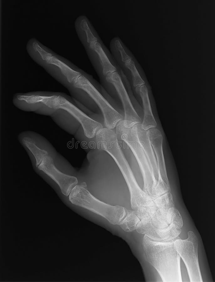 Strahl X Oder Röntgenbild Der Hand Stockfoto - Bild von digit, diagramm ...