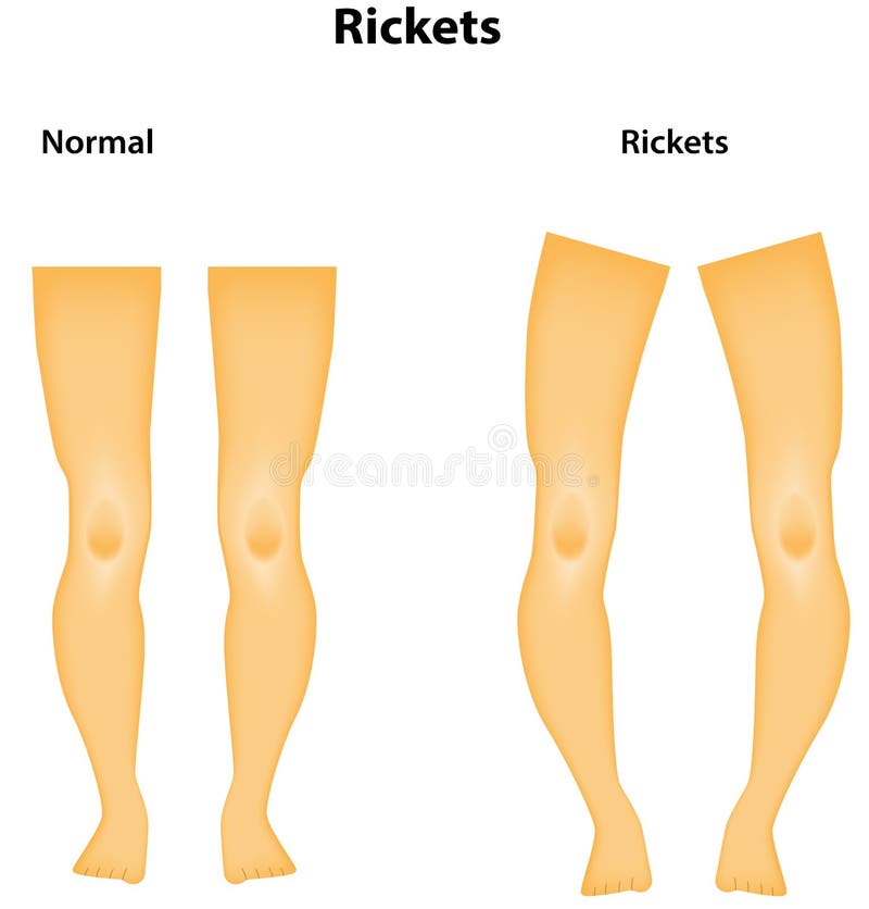 Rachitis vector illustratie. Illustration of been, knie - 41158592