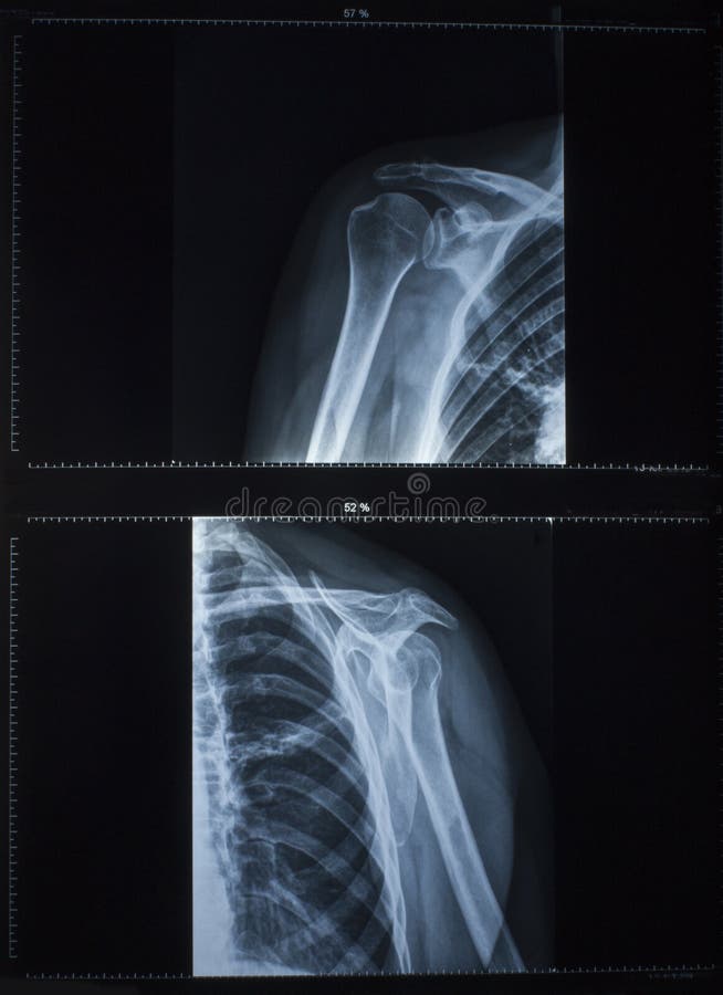 Radio Graphs Head of Humerus Stock Image - Image of joint, film: 58787769