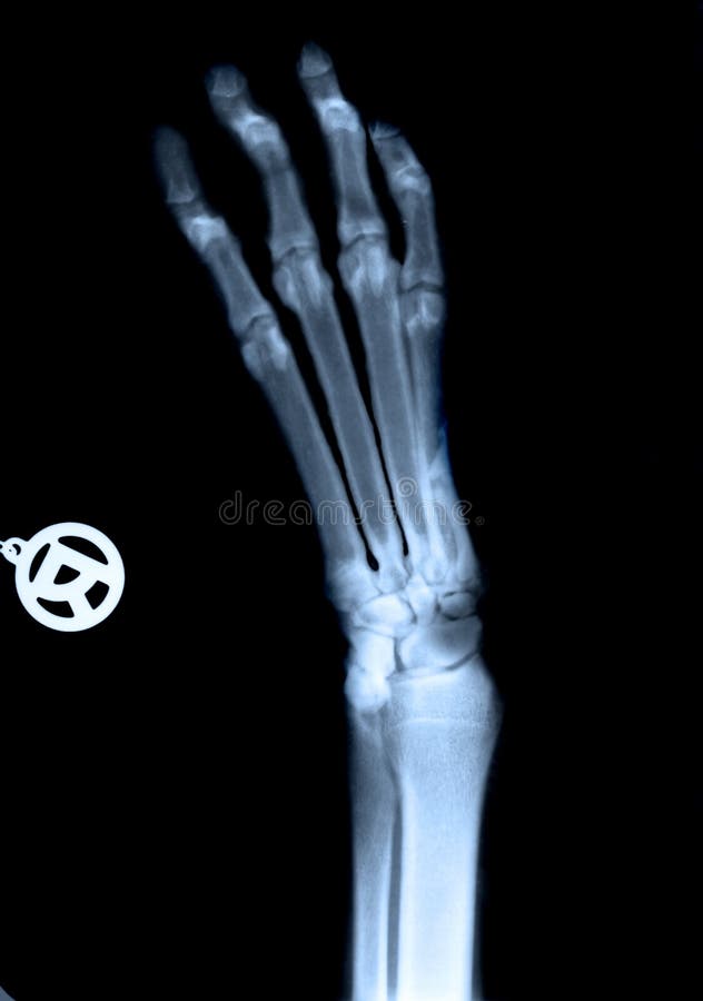 Perro X Ray Mostrando Falanges En Los Pies. Radiografía De Dedos Imagen ...