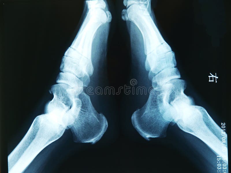 Radiografía del talón imagen de archivo. Imagen de talón - 10900219