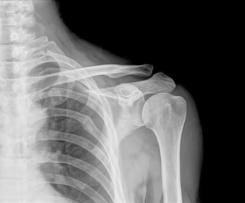 473 Radiografía Del Hombro Fotos - Libres de Derechos y Gratuitas de ...