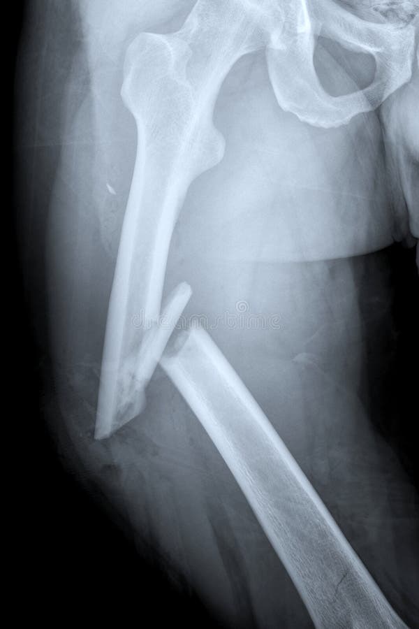 Radiografía Quebrada De La Tibia Imagen de archivo - Imagen de imagen ...