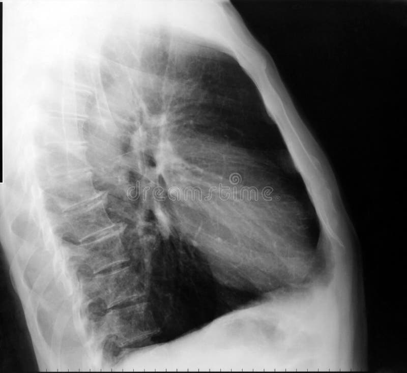 Placa Sana De La Radiografía De La Exploración Del Pecho. Imagen de ...