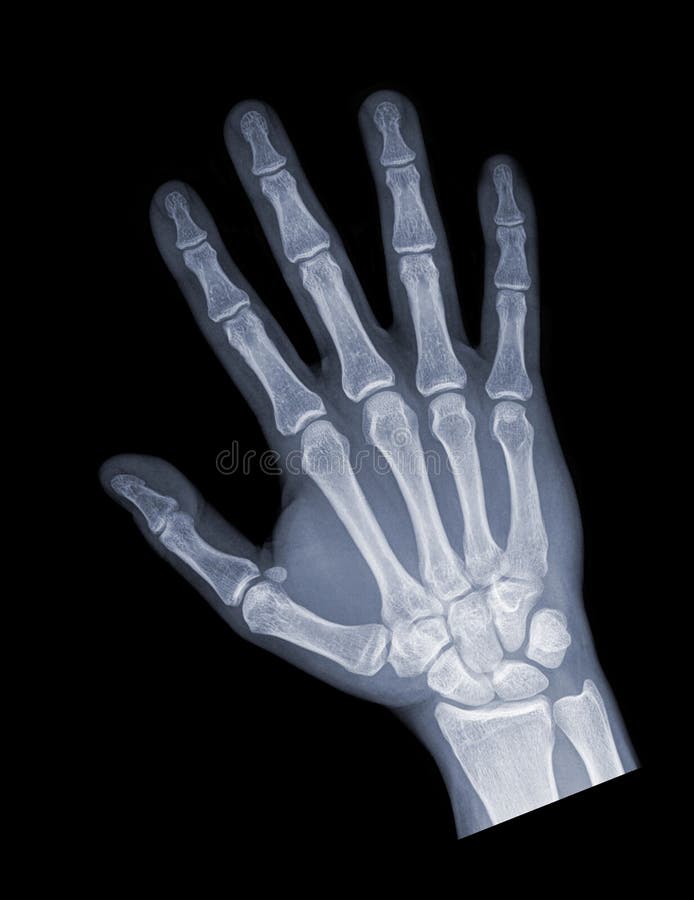 Radiografía De La Mano De Una Anciana Foto de archivo - Imagen de hueso ...