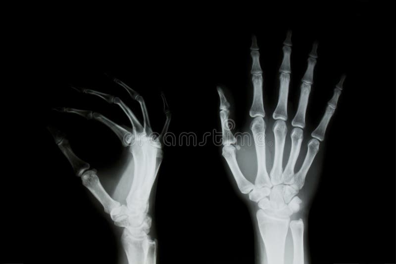 Radiografía De La Mano Humana (ACEPTABLE!) Foto de archivo - Imagen de ...