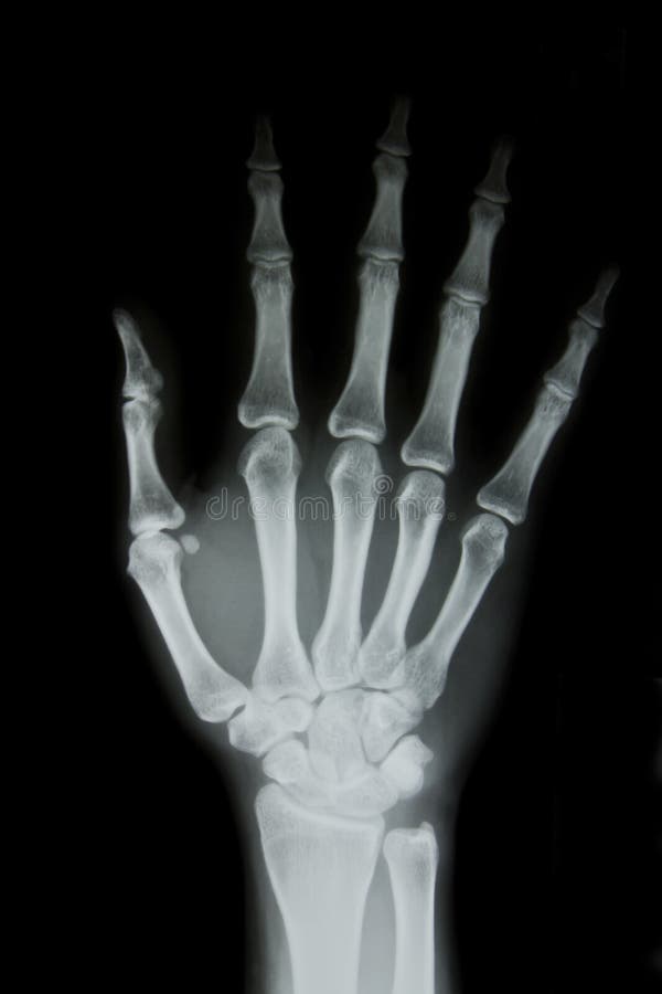 Radiografía De La Mano Humana Imagen de archivo - Imagen de trauma ...