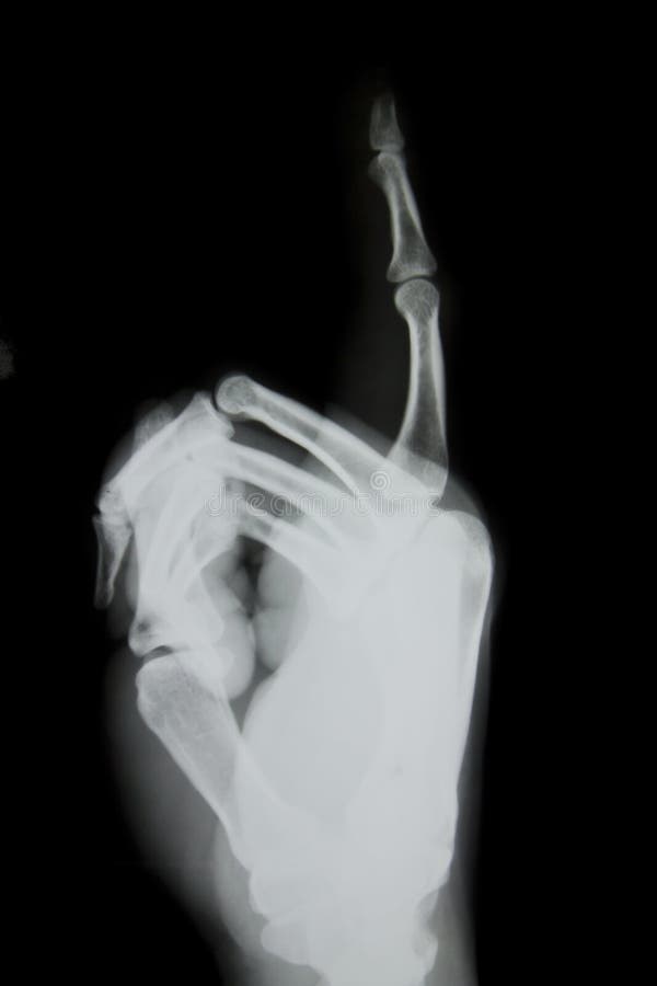 Radiografía De La Mano Humana Imagen de archivo - Imagen de segmento ...