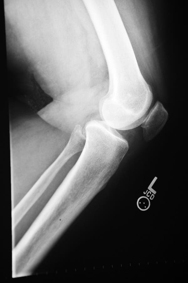 Rodilla Normal De La Radiografía Imagen de archivo - Imagen de roto ...