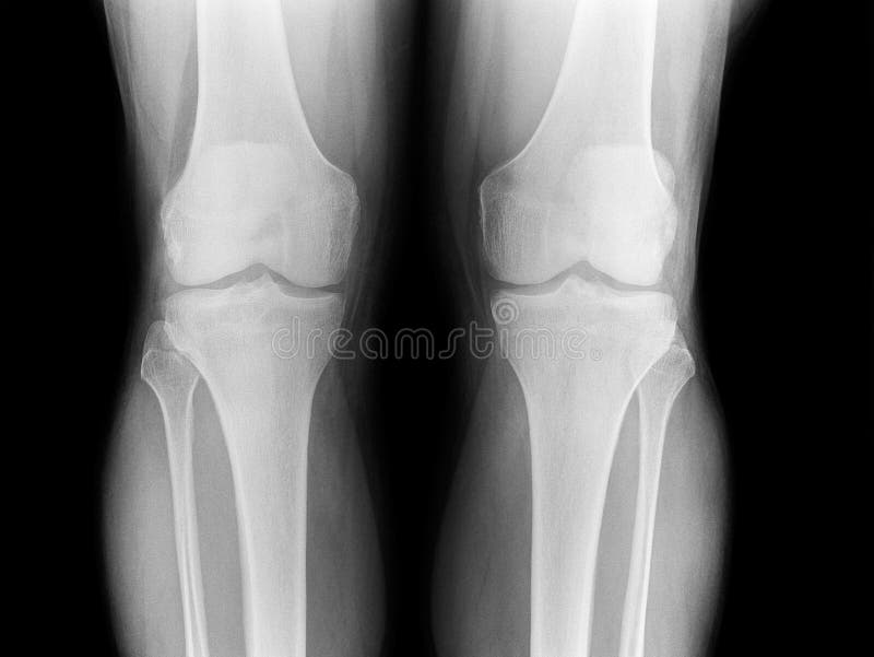 Radiografía Quebrada De La Tibia Imagen de archivo - Imagen de imagen ...