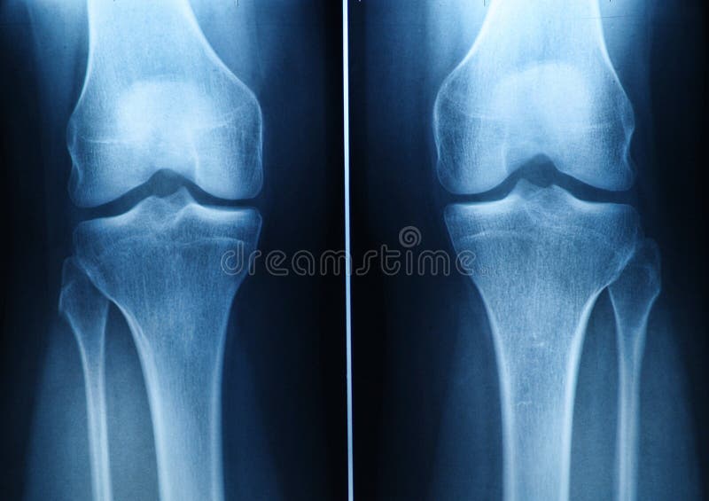 Radiografía Normal De La Rodilla Imagen de archivo - Imagen de cuadro ...