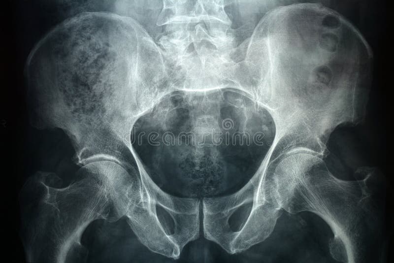 Radiografía Masculina De La Pelvis Imagen de archivo - Imagen de ...