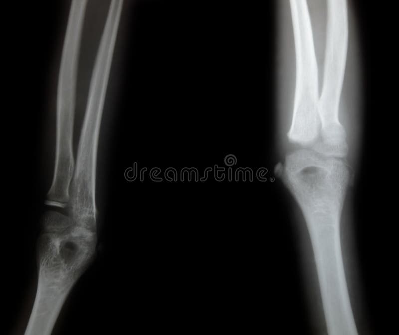 Radiografía De Un Brazo De Hombre Joven Imagen de archivo - Imagen de ...