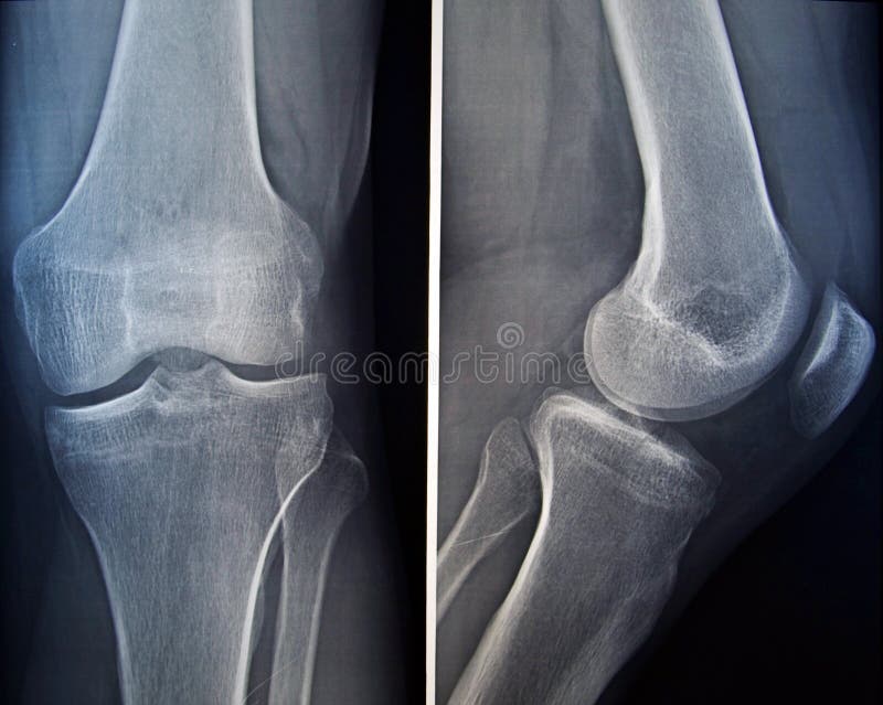 Radiografía De La Junta De Rodilla Derecha Fractura Del Cóndilo Lateral ...