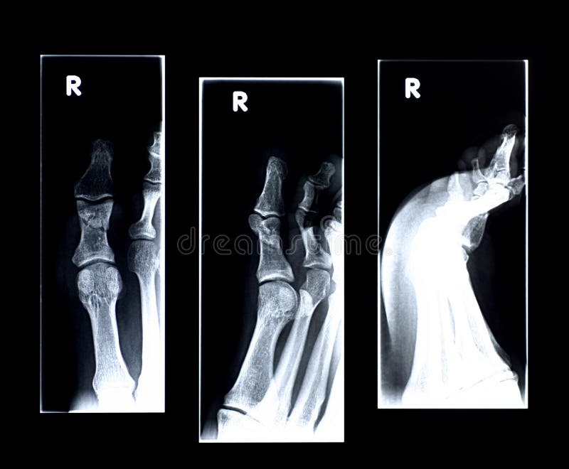 Hueso Roto Radiografía Del Dedo Foto de archivo - Imagen de huesos ...