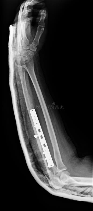 Radiografía Del Brazo Humano Imagen de archivo - Imagen de radio ...