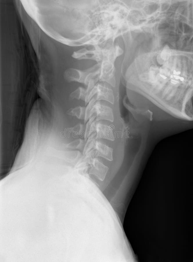 Radiografía del cuello foto de archivo. Imagen de quijada - 7110782