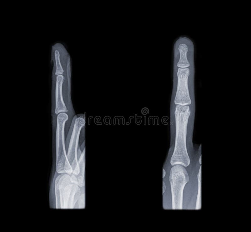 Radiografía del dedo imagen de archivo. Imagen de artritis - 14031903