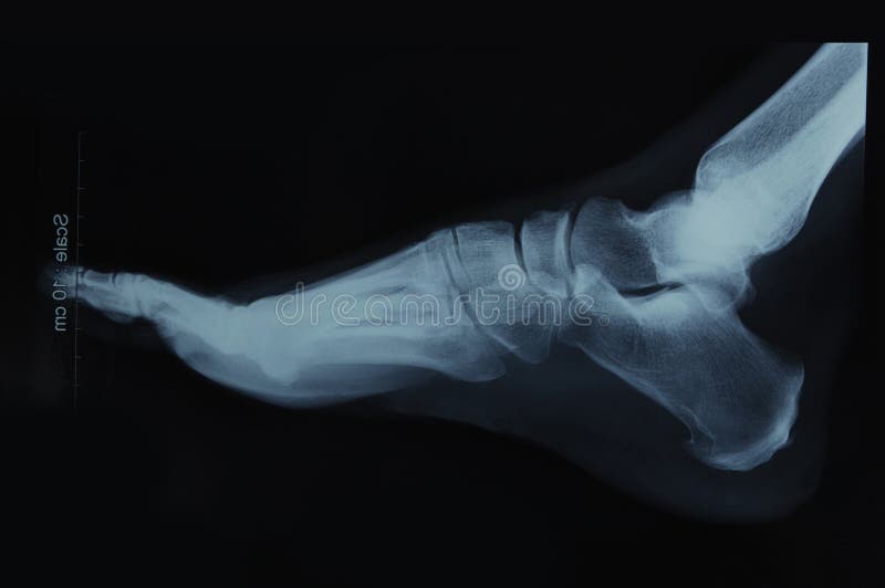 Radiografía del pie foto de archivo. Imagen de rayo, roto - 1221588
