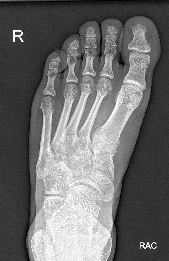 Radiografía Médica Del Pie, Huesos Más Bajos Del Miembro, Tobillo Roto ...