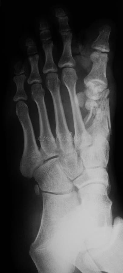 Radiografíe La Imagen Del Pie Quebrado, Del AP Y De La Visión Lateral ...