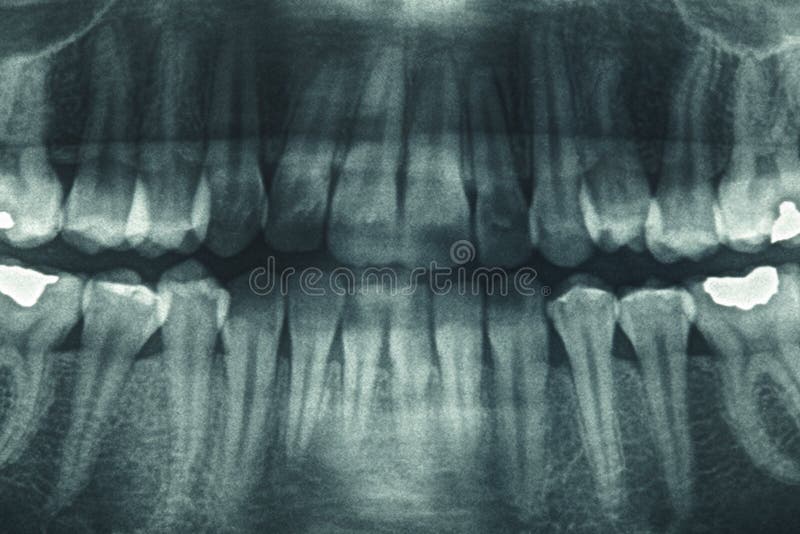 Radiografía Dental Panorámica Foto de archivo - Imagen de diente ...