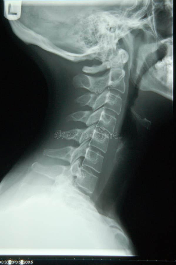 Radiografía Humana Del Cuello Foto de archivo - Imagen de izquierdo ...