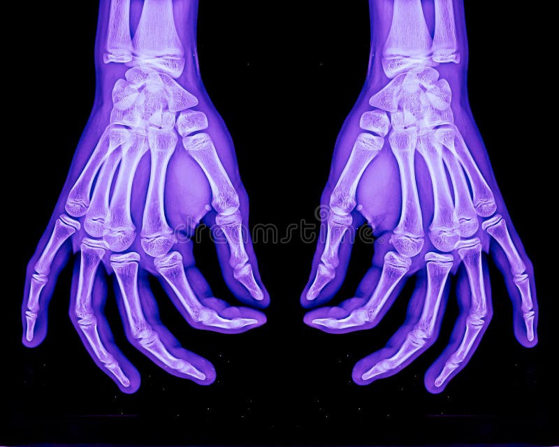 Radiografía Normal De Ambas Manos Imagen de archivo - Imagen de ...