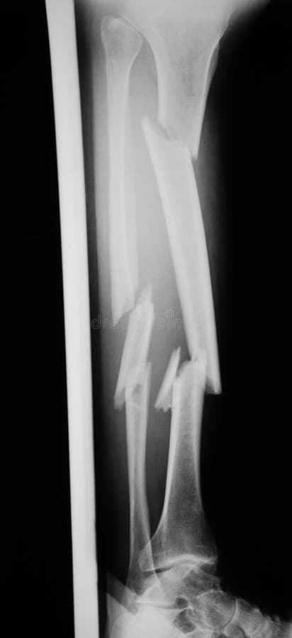 Radiografia Do Pé Quebrado (tíbia Quebrada) Foto de Stock - Imagem de ...