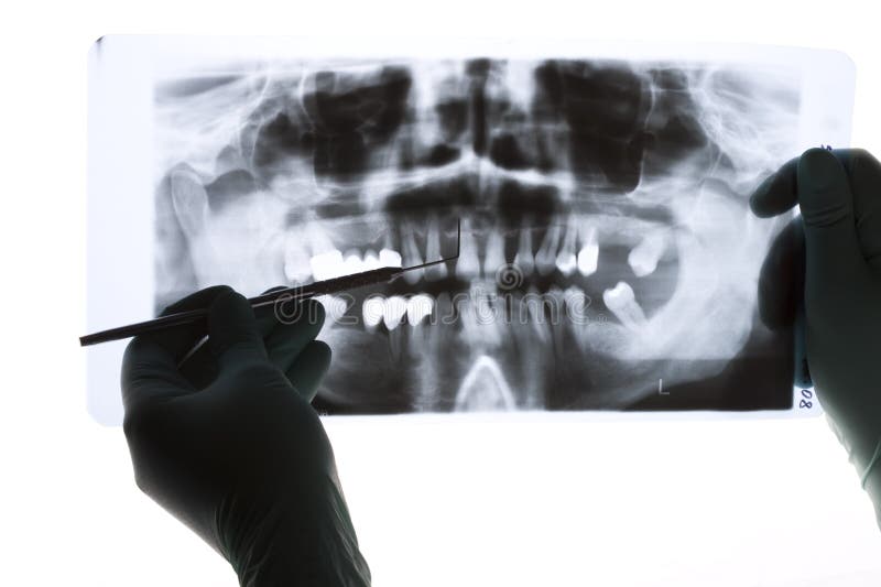 Radiografia imagem de stock. Imagem de panorâmica, esqueleto - 11777683